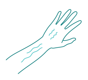 Arm Veins & Hand Veins Causes, Symptoms & Treatments | Vein Doctor