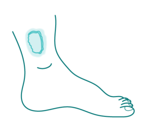Treating Leg Ulcers Effectively | Vein Doctor Australia