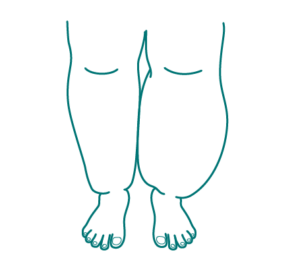 Managing Swollen Legs & Lipoedema | Vein Doctor Australia