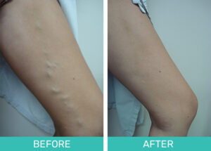 Case Studies | Vein Doctor - Patient vein treatments